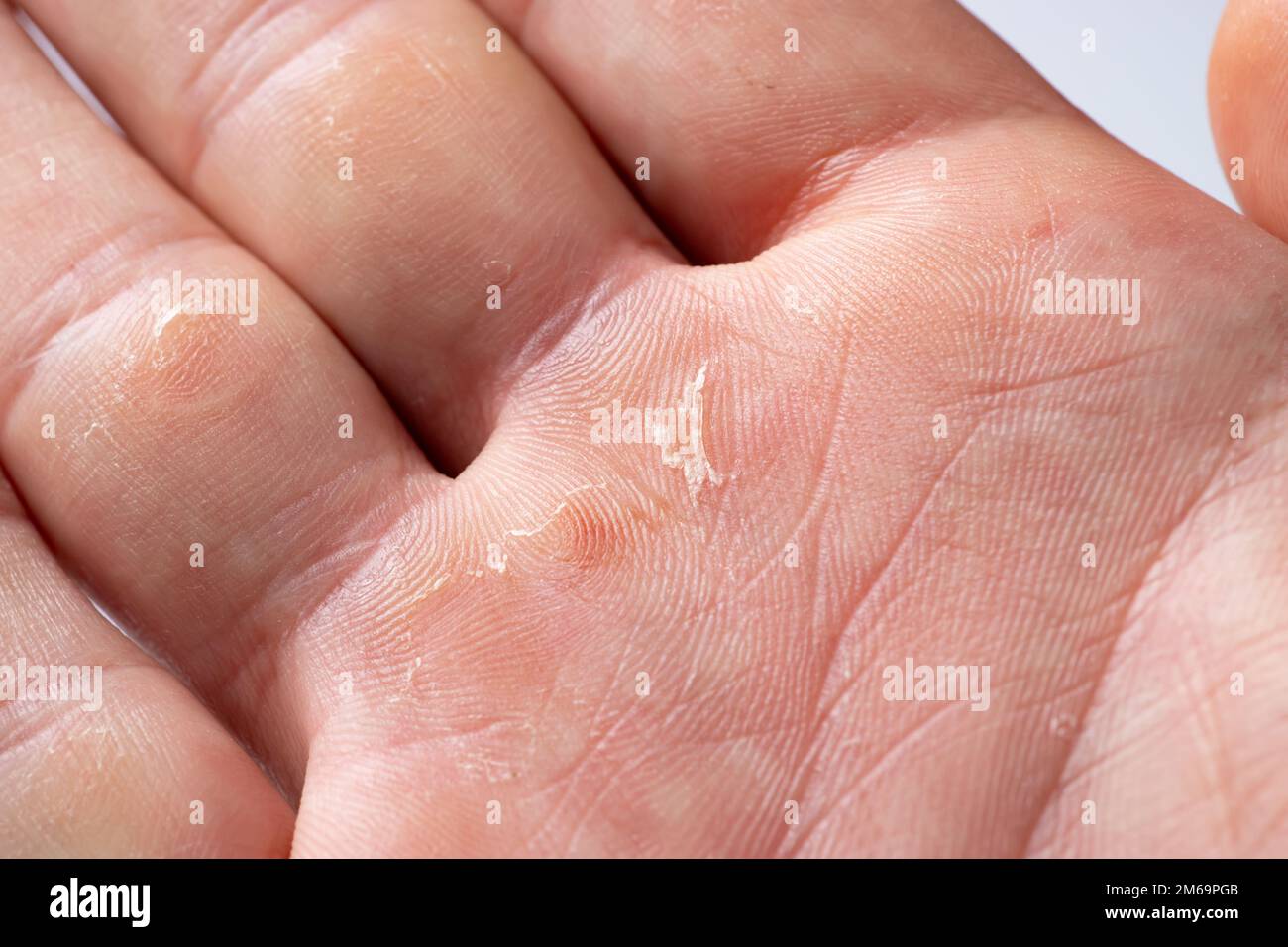 Callus finger hi-res stock photography and images - Alamy