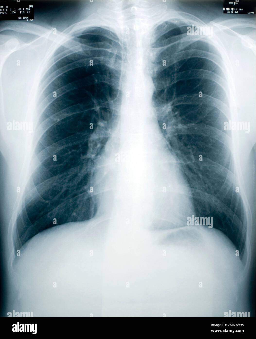 Tuberculosis lung x ray hi-res stock photography and images - Alamy