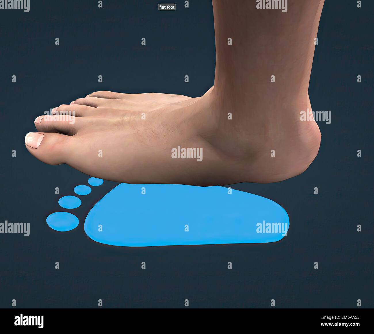Flat Feet Is A Common Condition In Which The Arches On The Inside Of flat-feet-is-a-common-condition-in-which-the-arches-on-the-inside-of