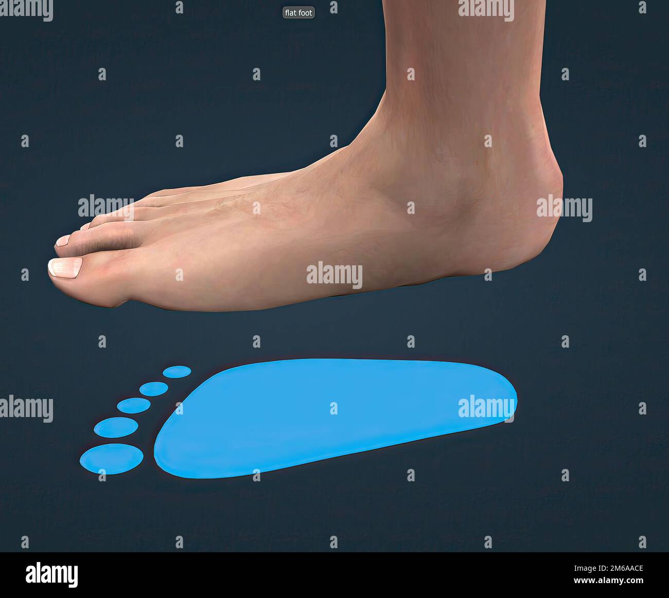 Longitudinal arch feet hi-res stock photography and images - Alamy