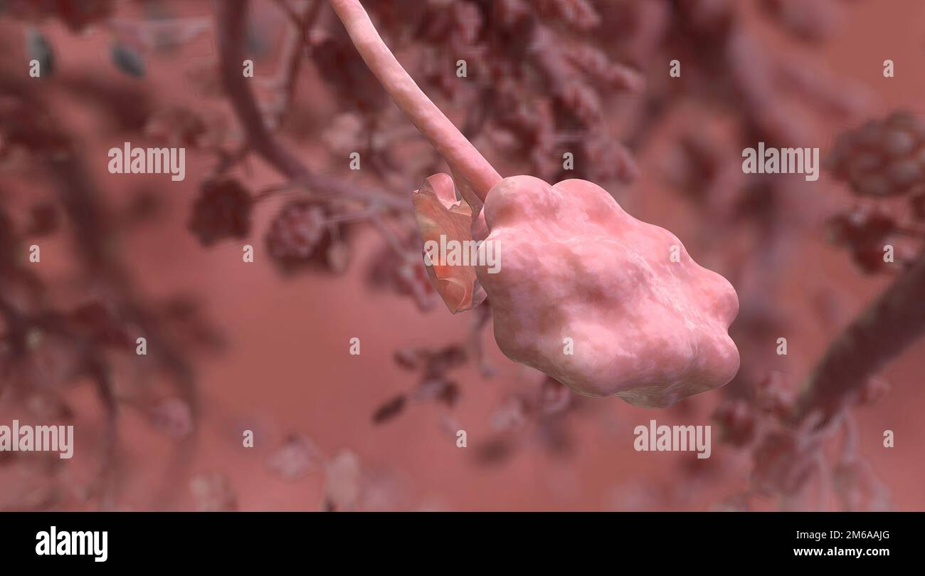 Damaged organs hi-res stock photography and images - Alamy