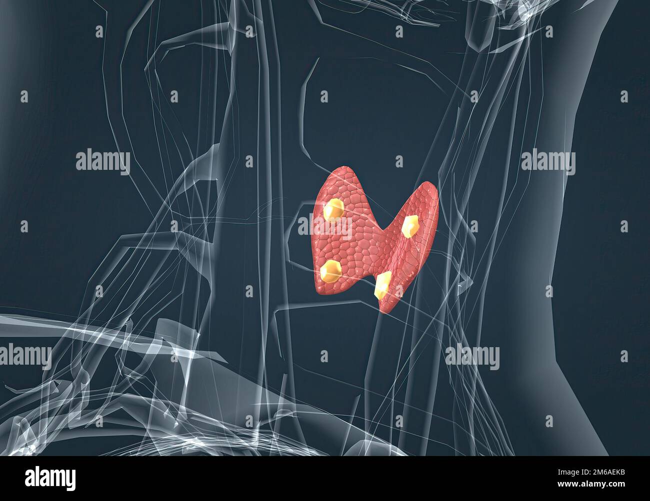 Multinodular toxic goiter hi-res stock photography and images - Alamy