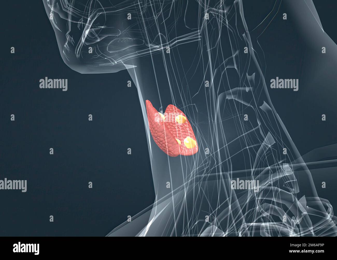 Multinodular toxic goiter hi-res stock photography and images - Alamy
