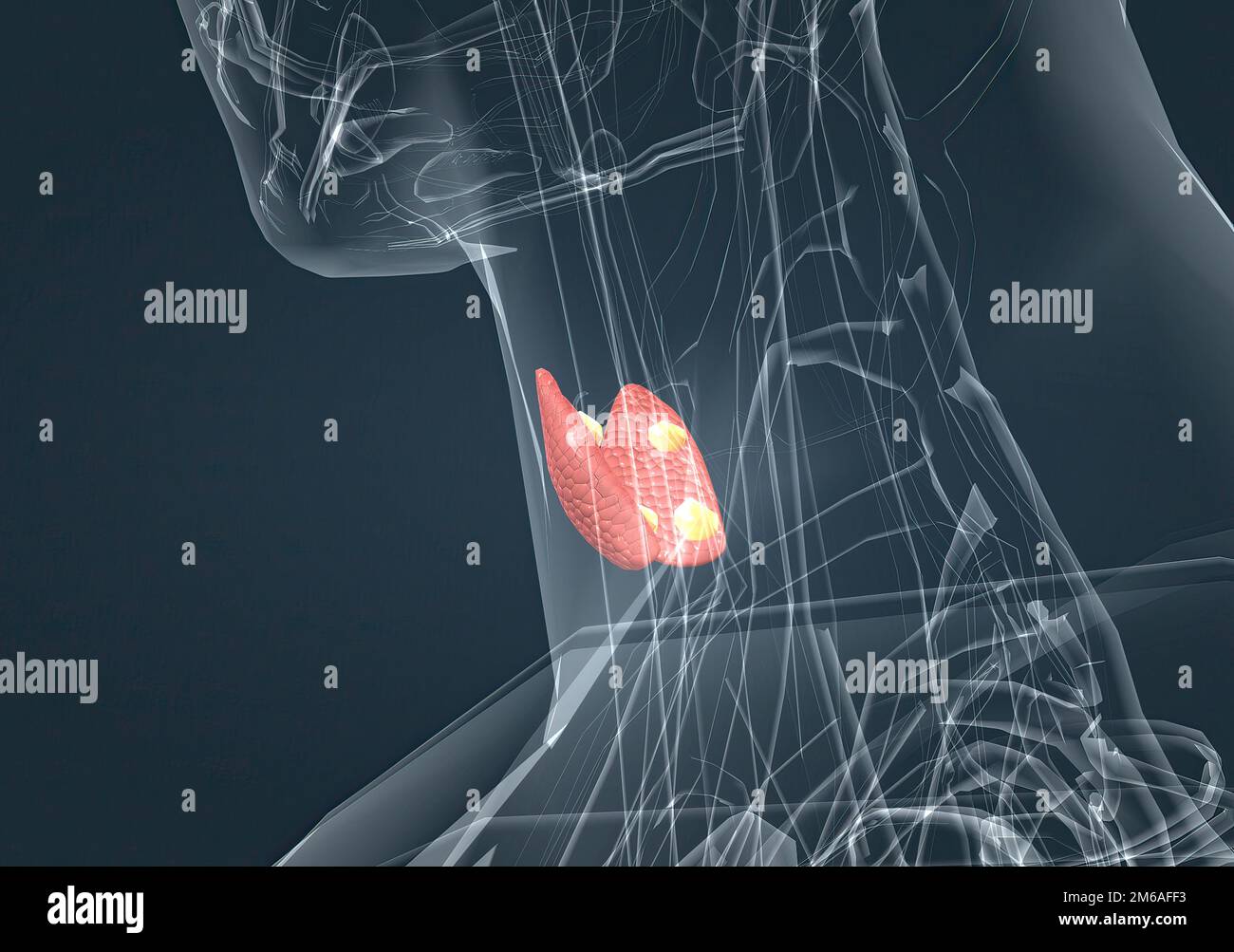 Multinodular toxic goiter hi-res stock photography and images - Alamy
