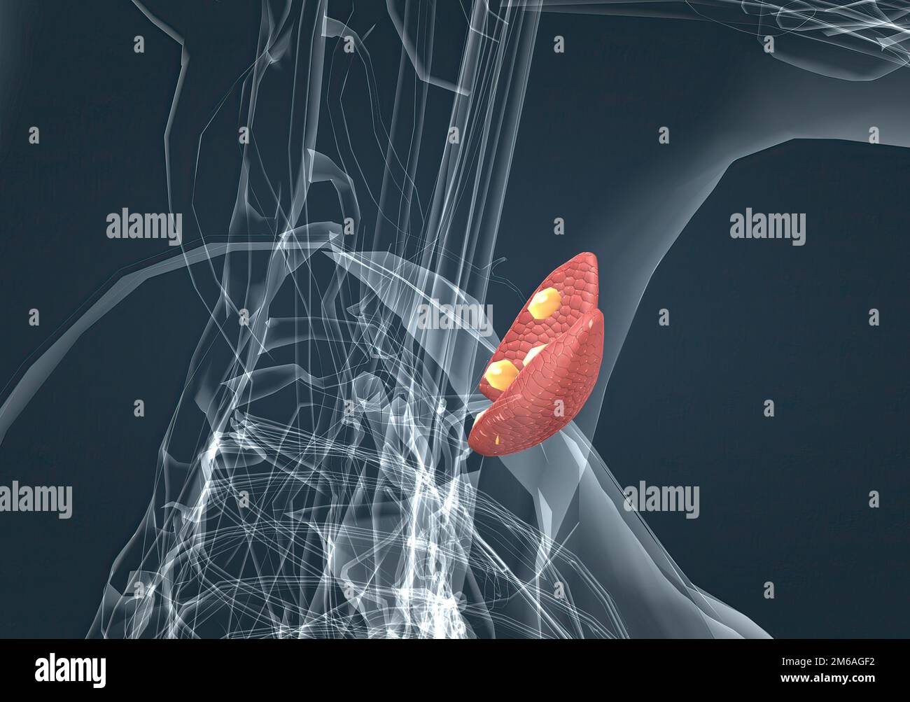 Multinodular goiter hi-res stock photography and images - Alamy