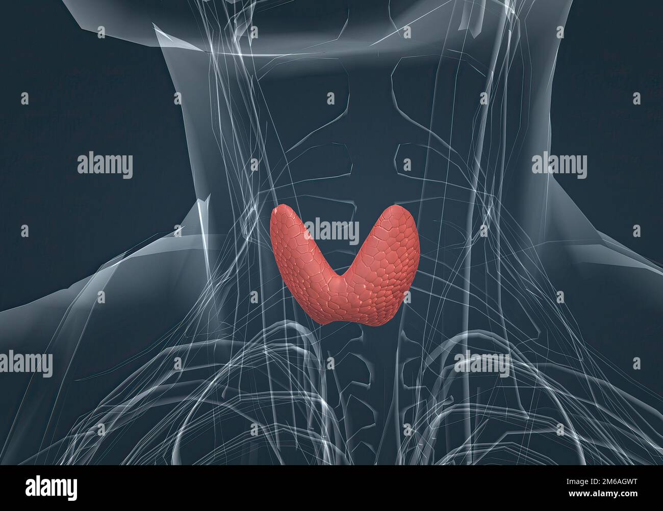 Multinodular toxic goiter hi-res stock photography and images - Alamy