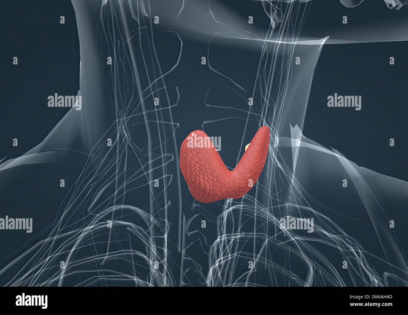 Multinodular toxic goiter hi-res stock photography and images - Alamy