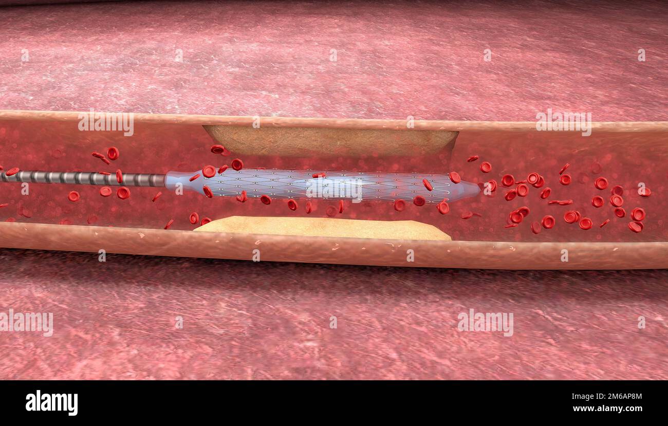 Patient with stent hi-res stock photography and images - Alamy