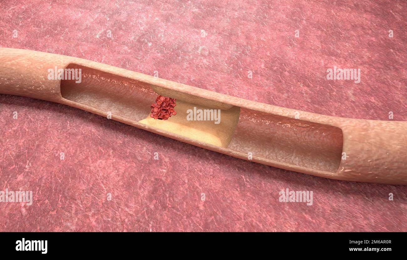 The Blockage In The Veins Is Called Chronic Venous Obstruction 3d