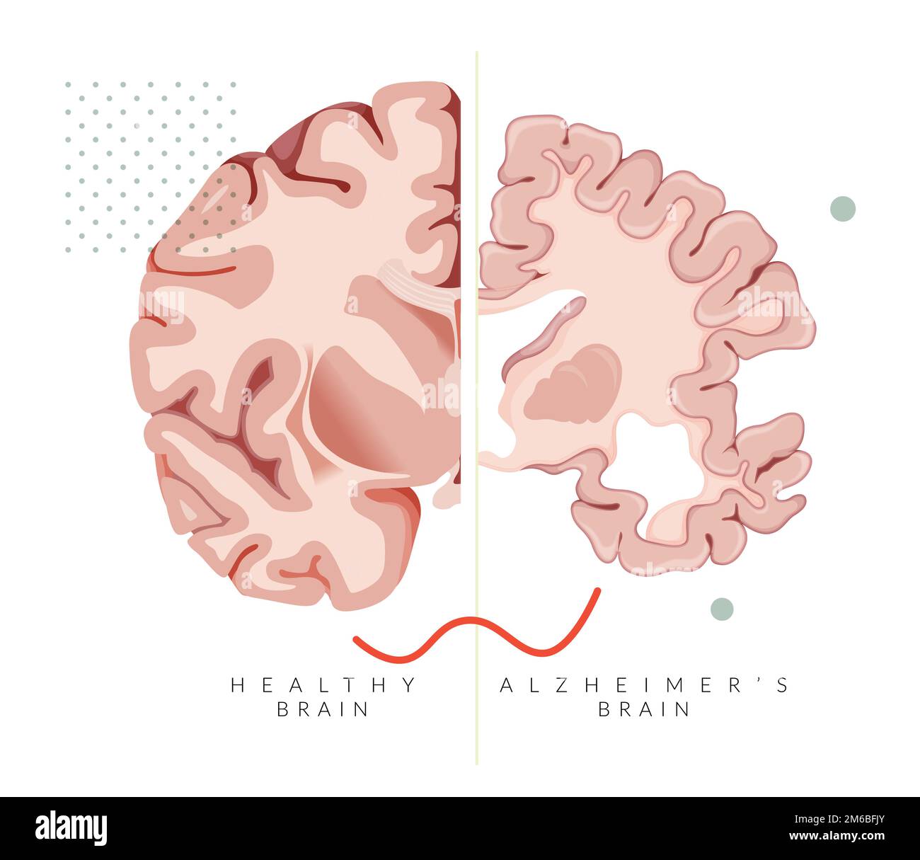 Alzheimers Disease Brain Transverse Section Compare With Healthy Brain Illustration As Eps