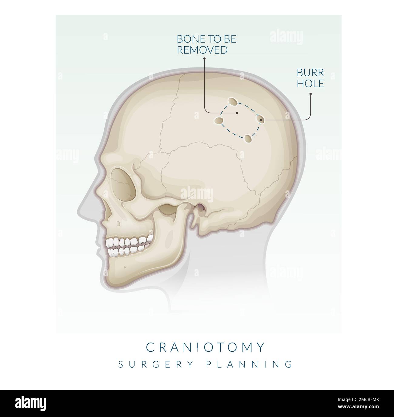 Craniotomy hi-res stock photography and images - Alamy