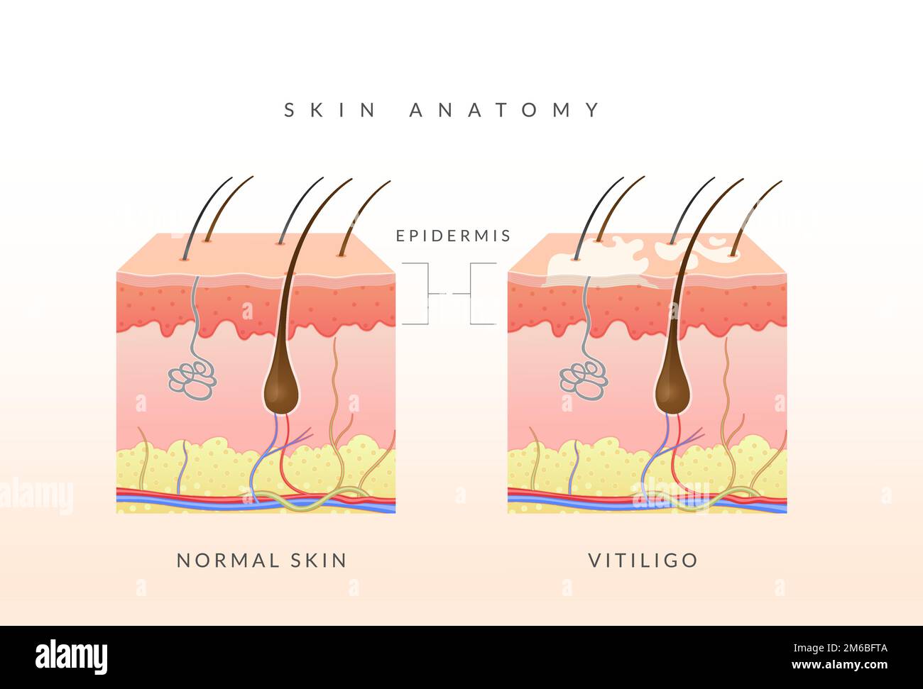 Anatomy of Skin and Skin with Vitiligo - Stock Illustration as EPS 10 ...
