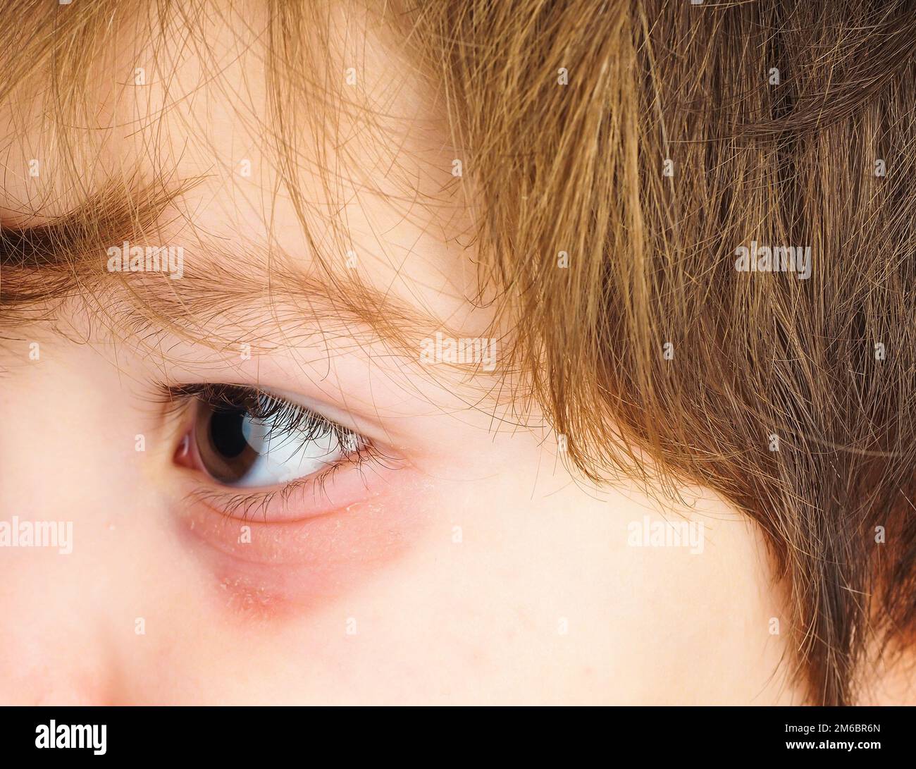 Pink eye on a boy child, at closeup with brown eye and brunette hair ...
