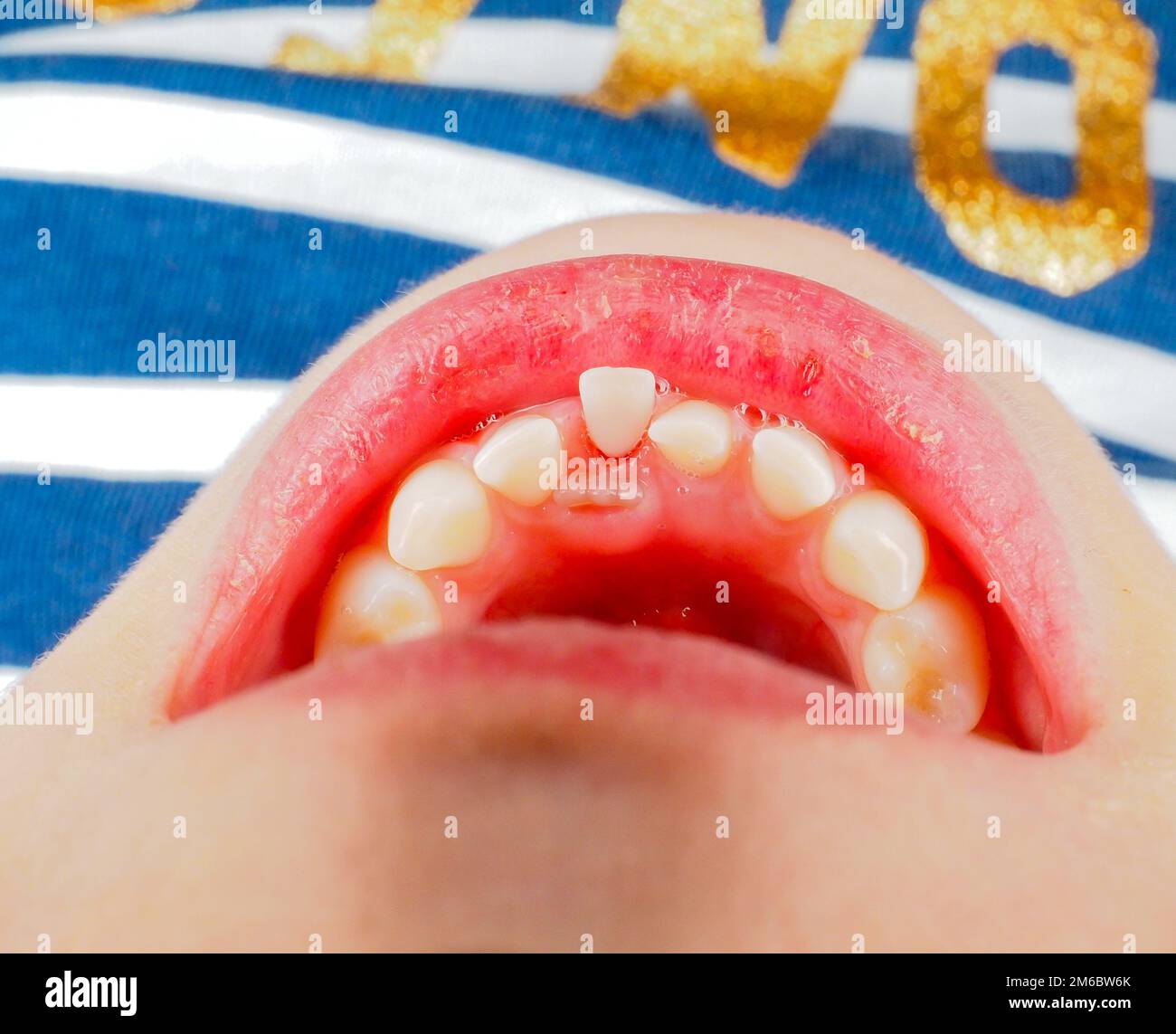 Child losing tooth hi-res stock photography and images - Alamy