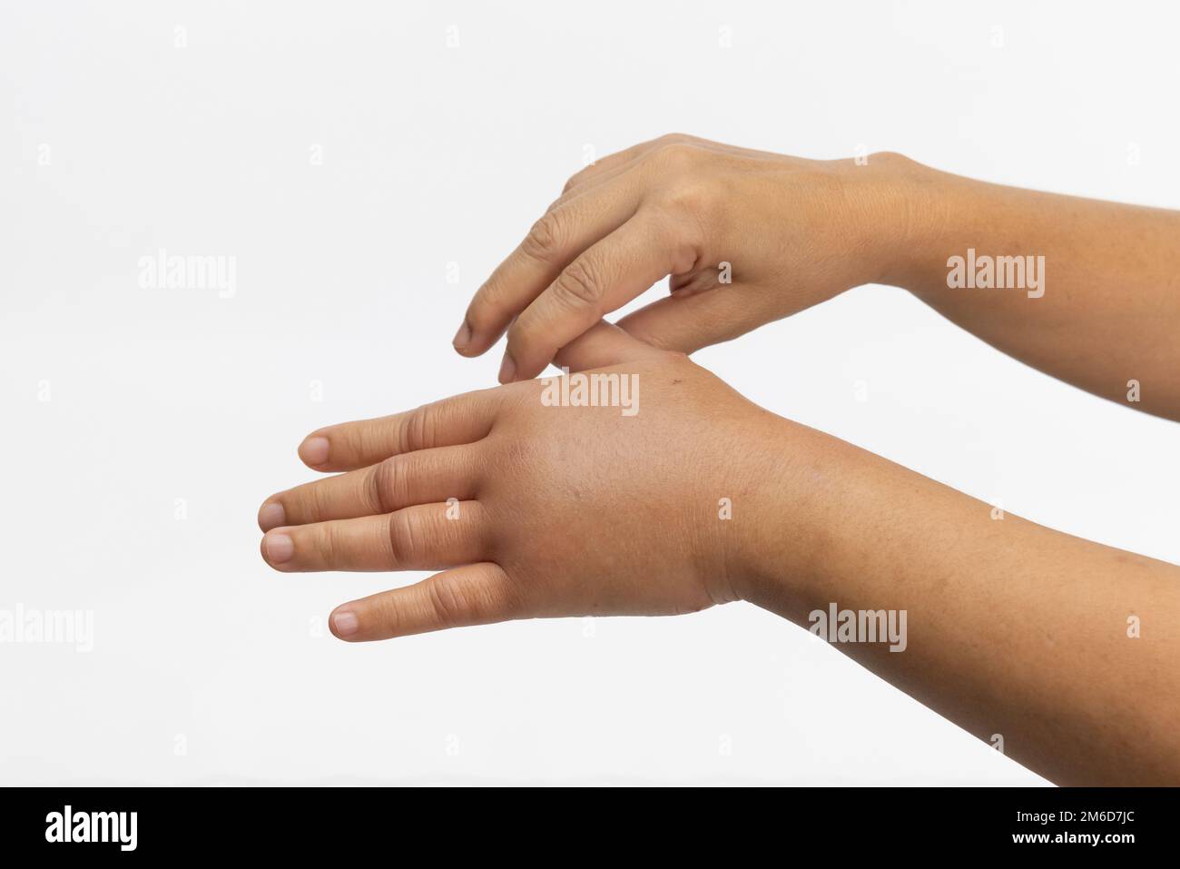 Swollen hand from allergic of insect stings. Skin allergic care Stock ...