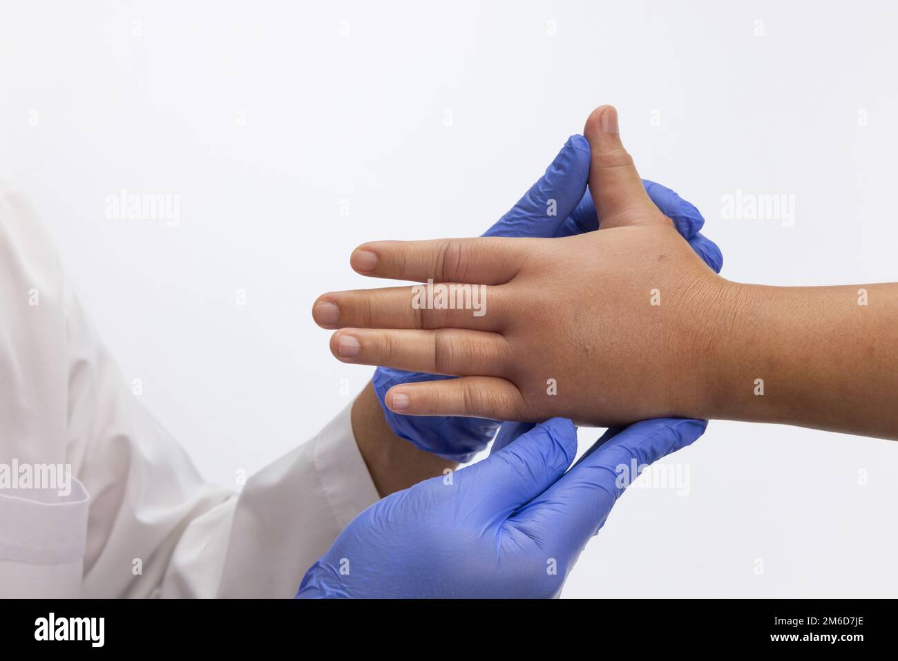 Swollen hand from allergic of insect stings. Skin allergic care Stock ...