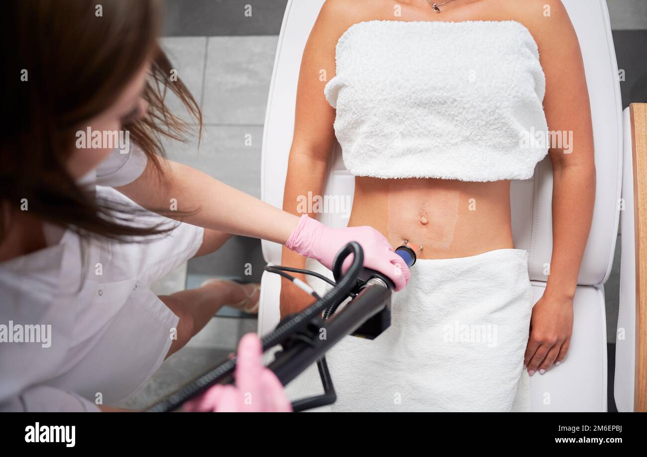 Woman's abdomen exposed to laser polishing. Visible traces in form of ...