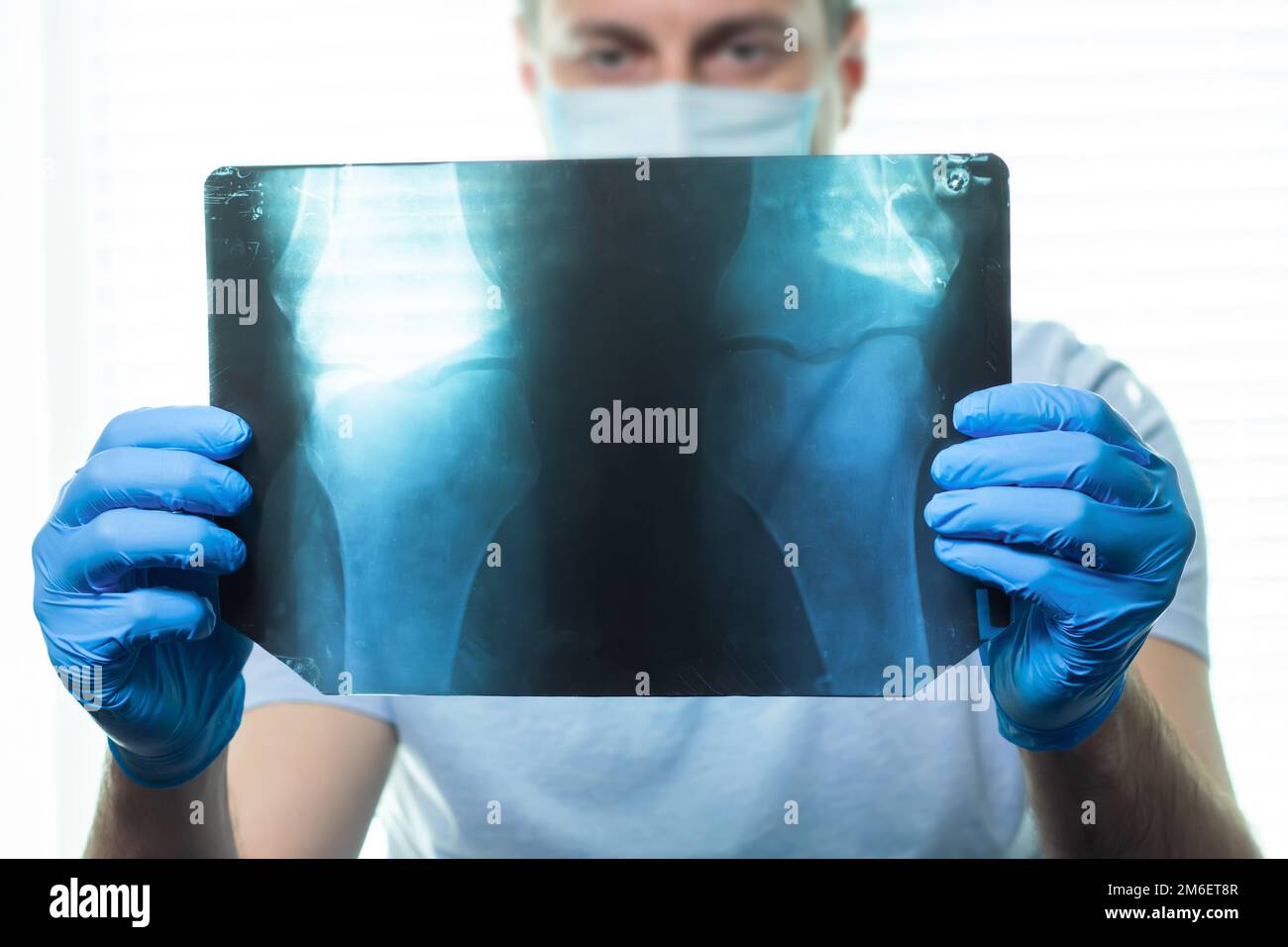 Doctor hold in hands x-ray film. OA knee x-ray image Posteo-anterior ...