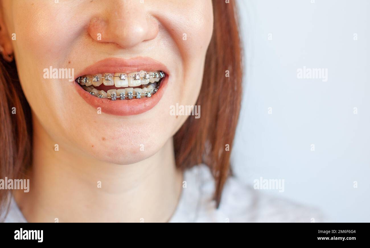 Braces in the smiling mouth of a girl. Smooth teeth from braces Stock ...