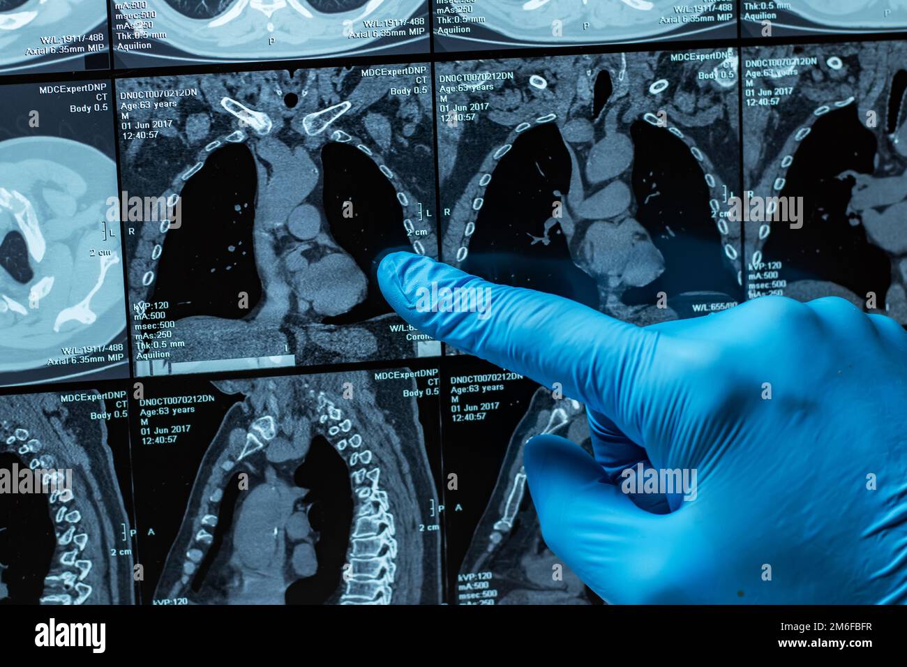 Ct mri stroke hi-res stock photography and images - Alamy