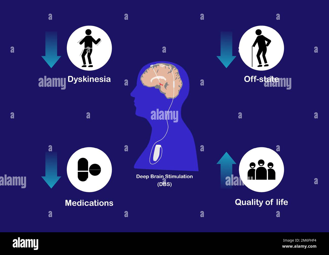 Effects of deep brain stimulation for treatment of advanced Parkinson's ...