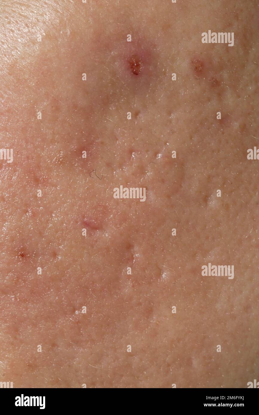 Extreme close-up of texture of problematic human skin with large ... Extreme close-up of texture of problematic human skin with large ...