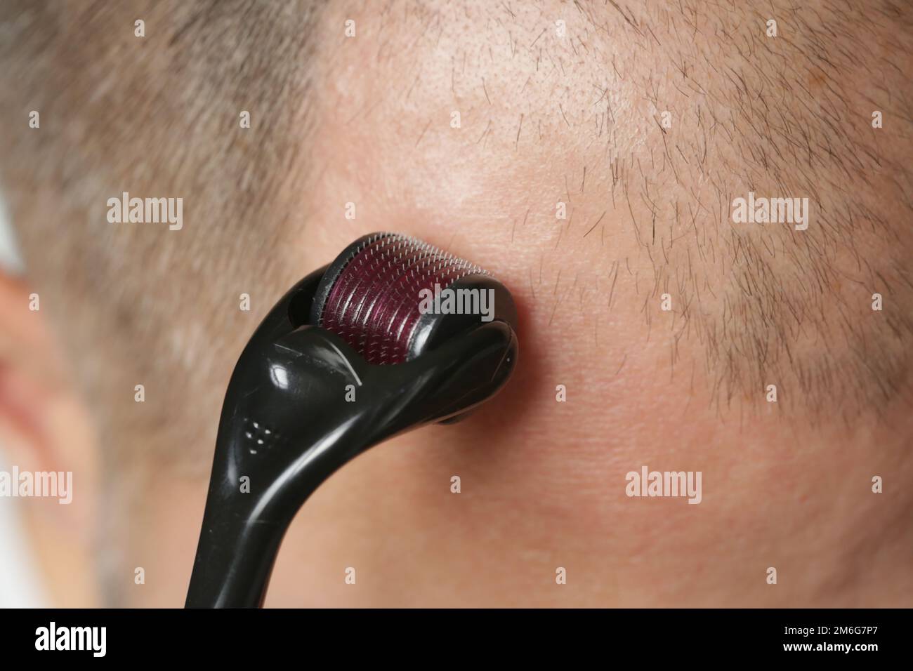 Men using microneedle derma roller on head for stimulating new hair ...