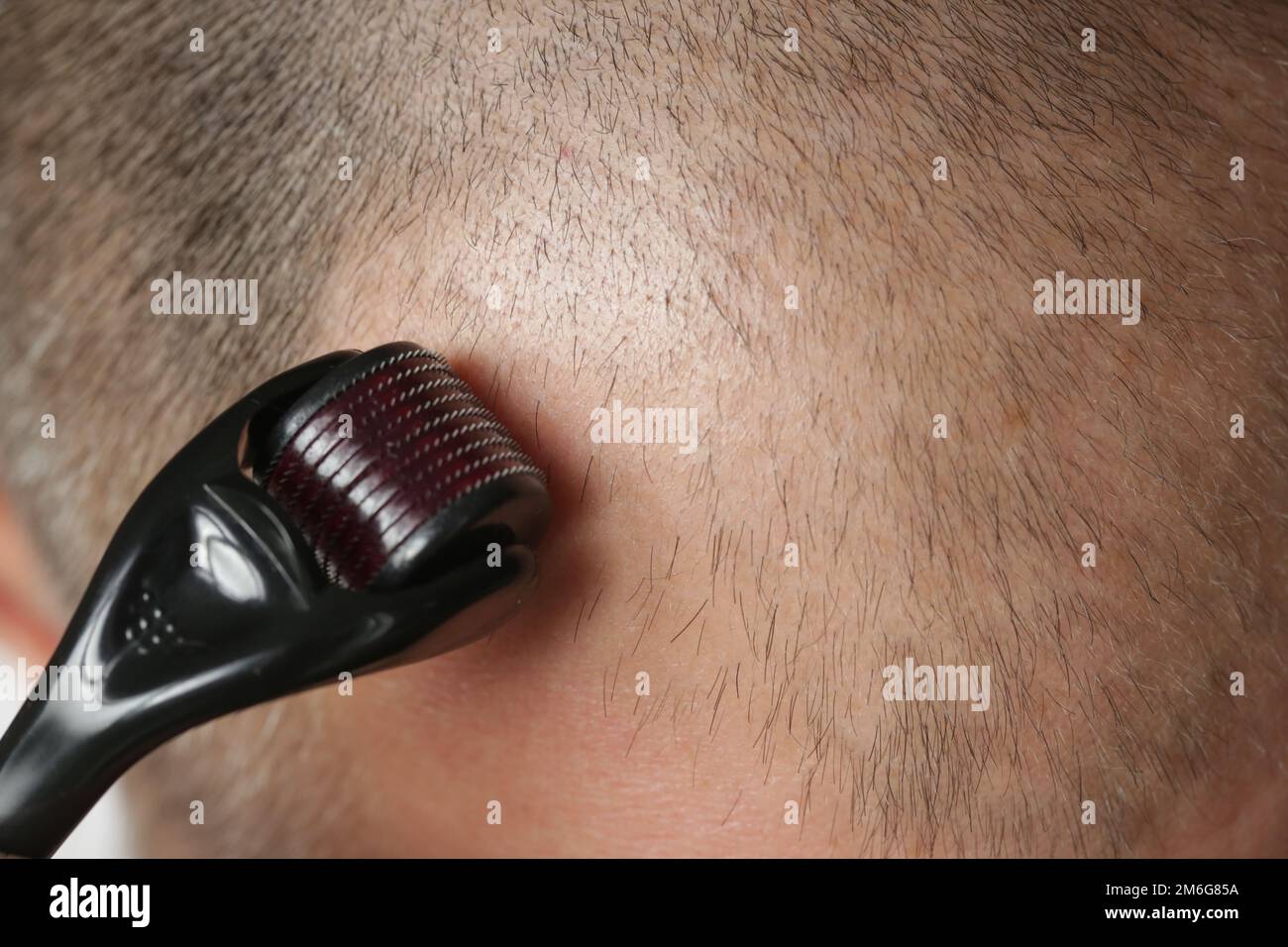 Men using microneedle derma roller on head for stimulating new hair ...