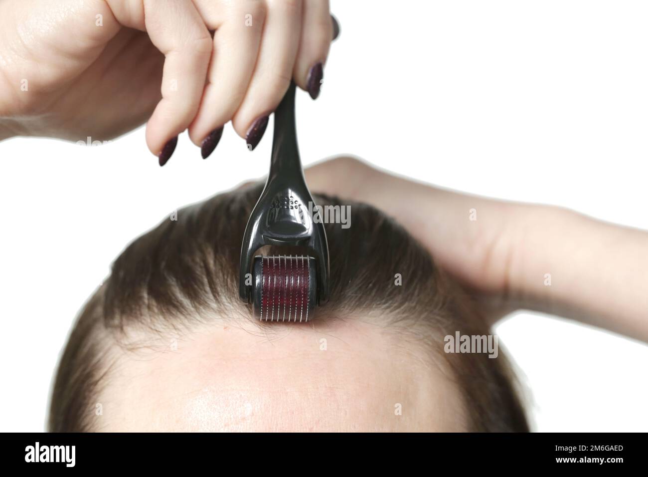 Woman using microneedle derma roller on head for stimulating new hair ...