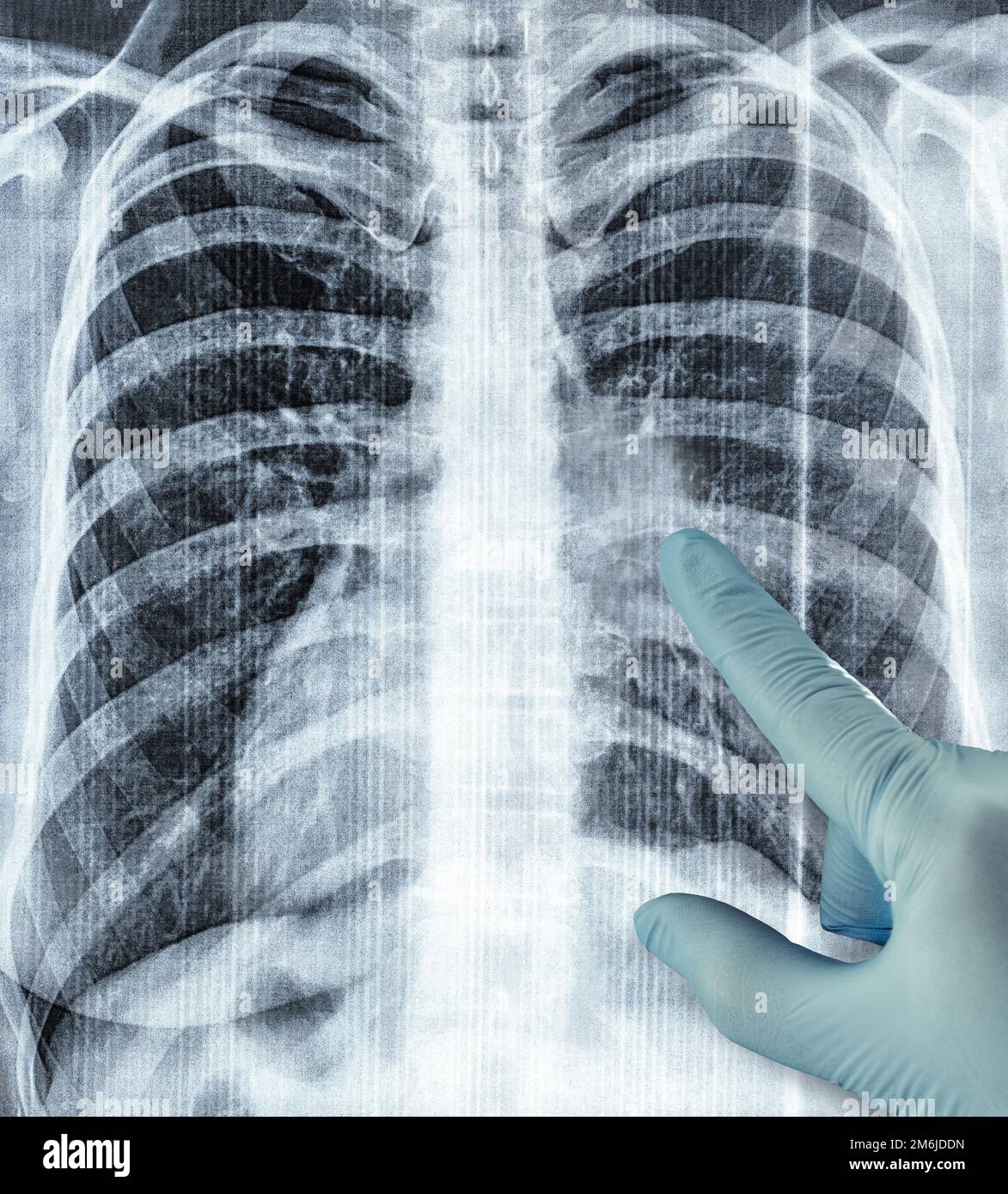 Pneumonia virus lung bones radiograph snapshot hand in glove Stock ...