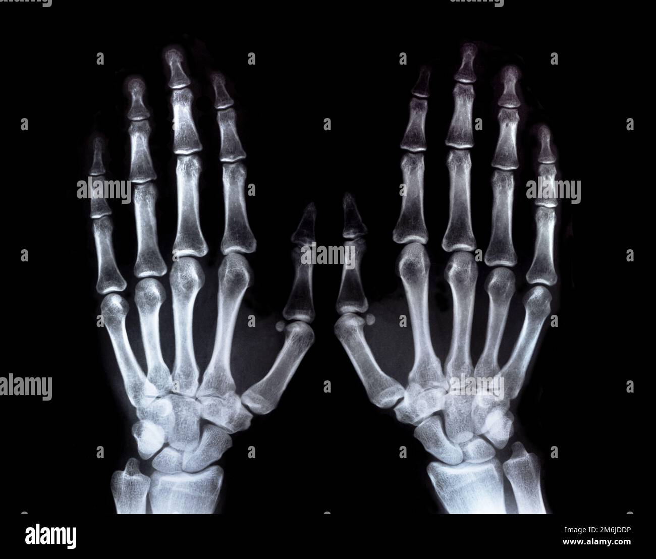 X ray fingers hi-res stock photography and images - Alamy