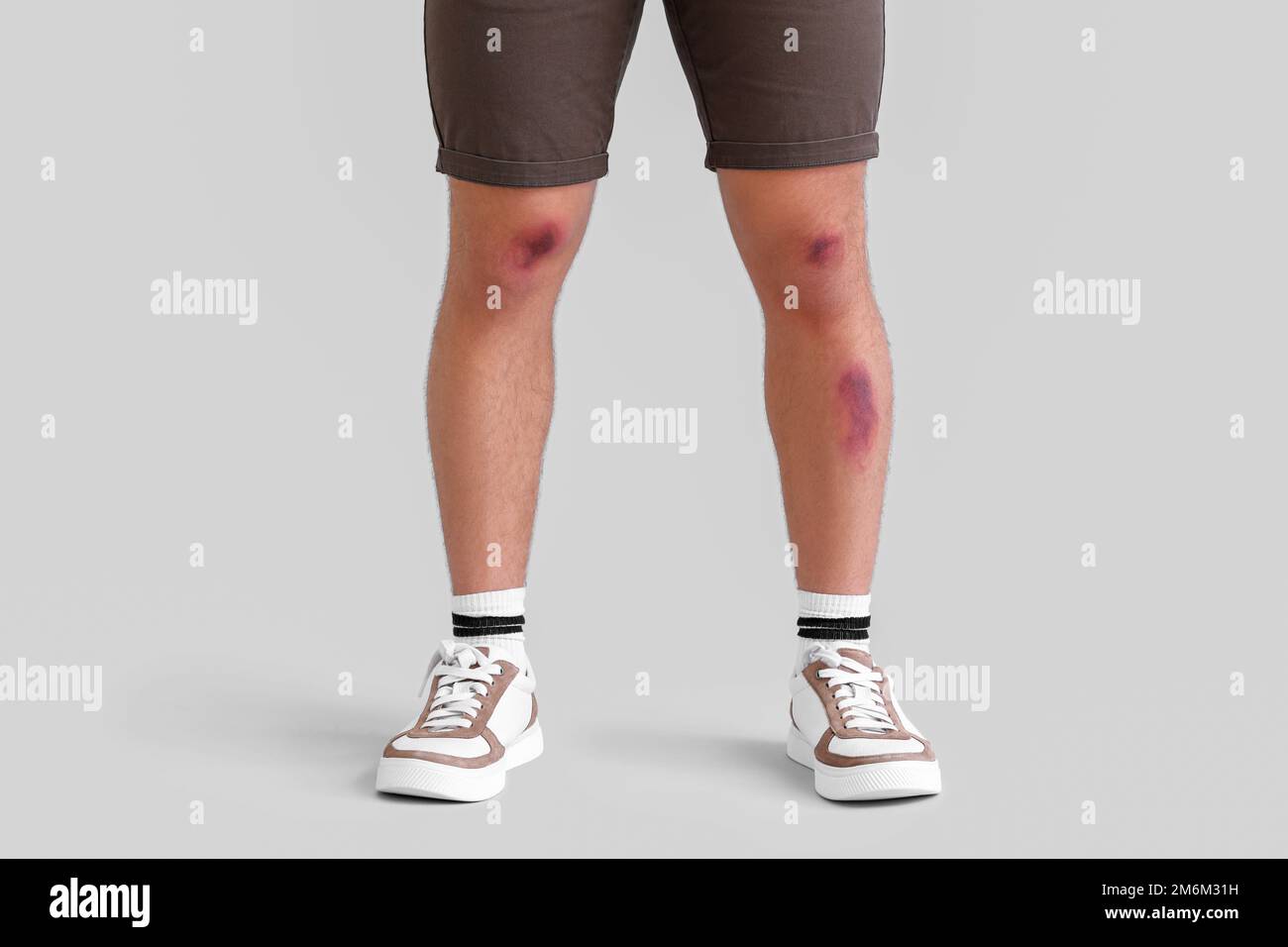 Man with bruises on legs against light background Stock Photo - Alamy