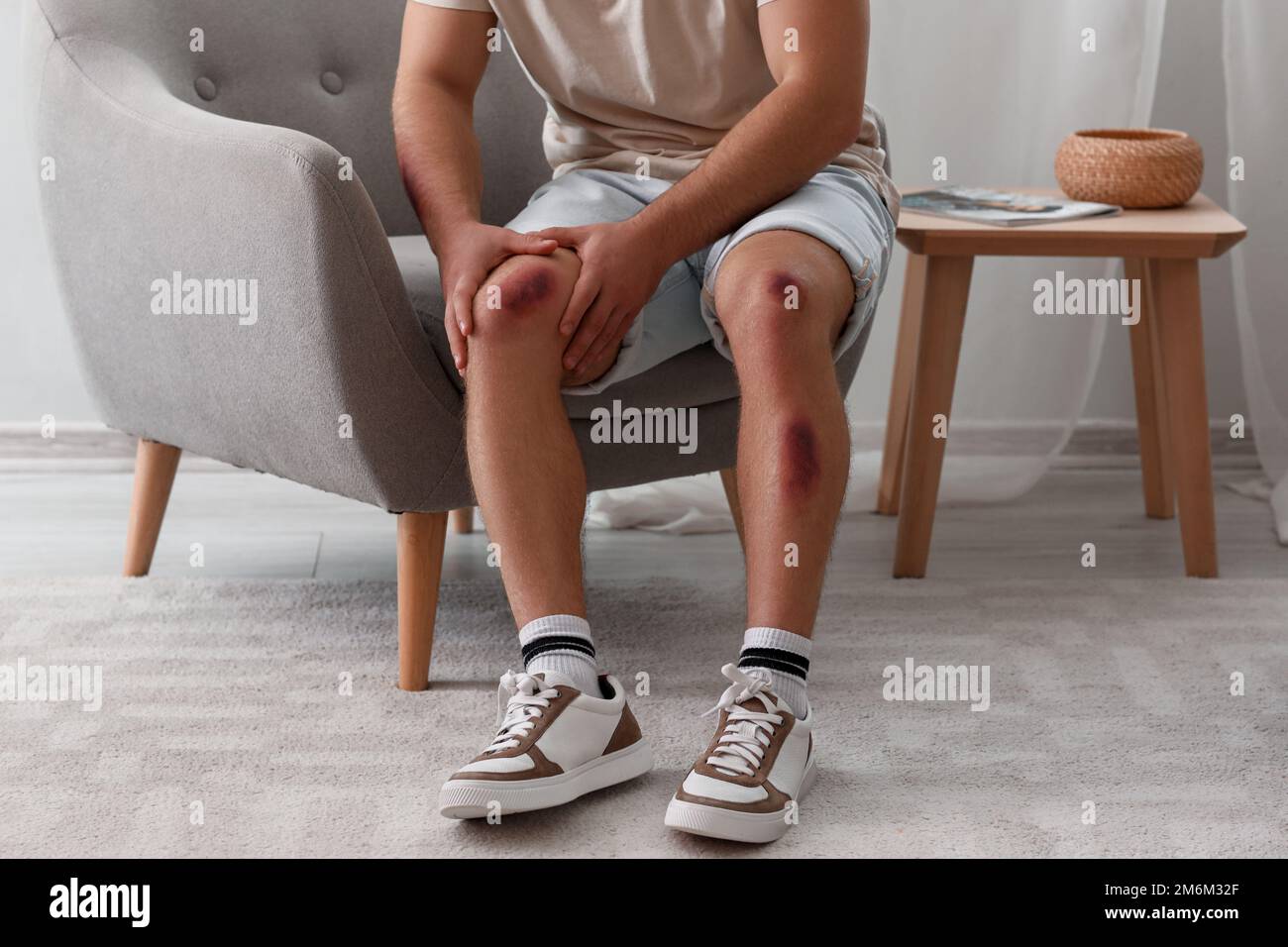 Man with bruises on his body at home Stock Photo - Alamy