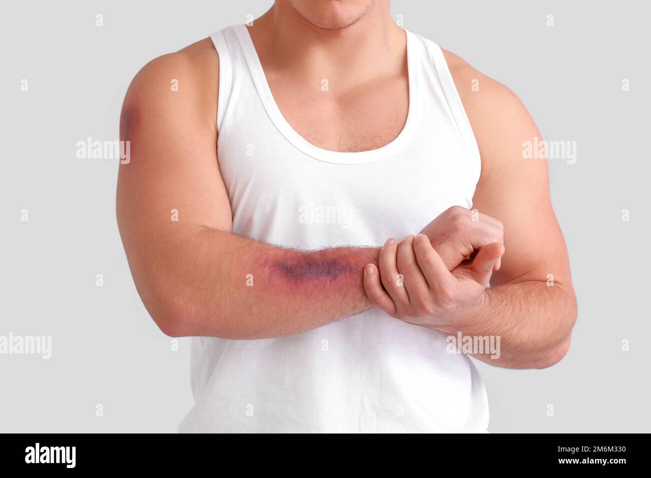 Man with bruises on arm against light background Stock Photo - Alamy