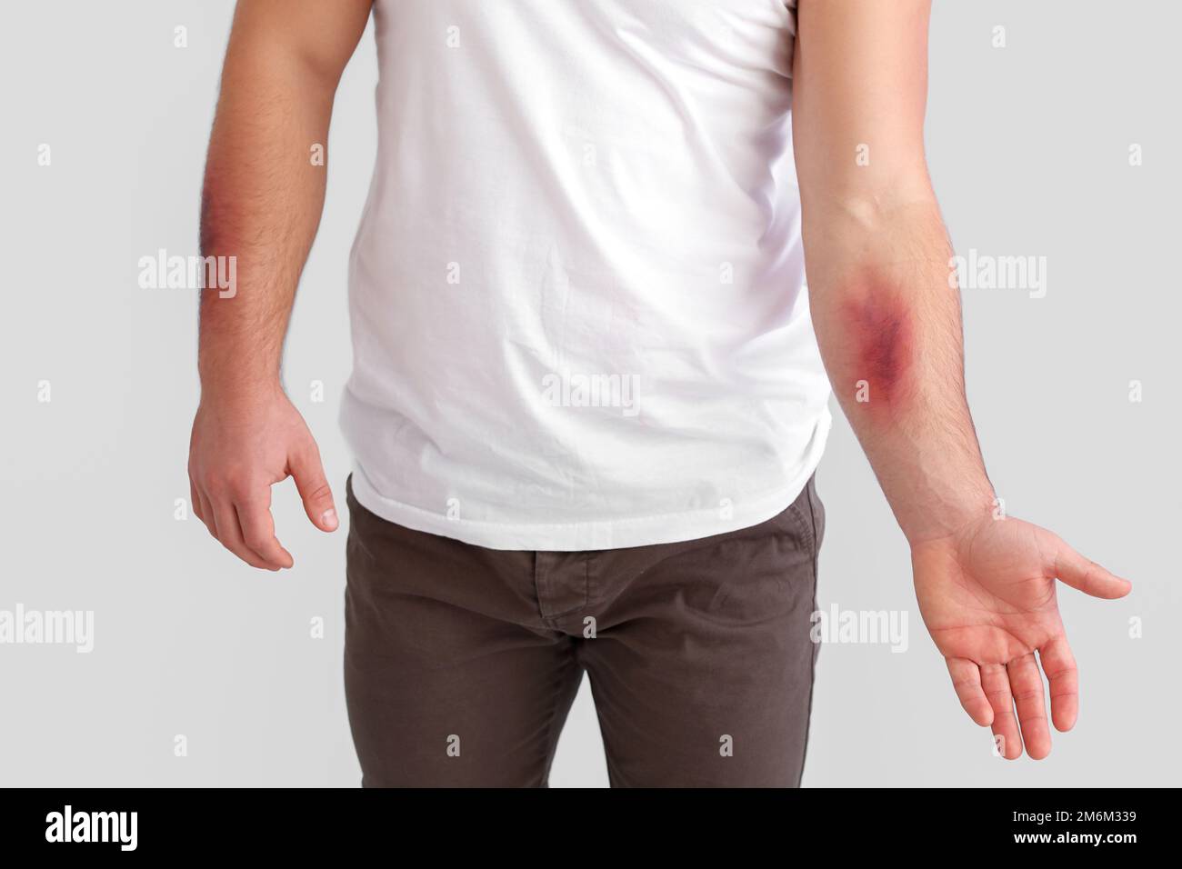 Man with bruises on arms against light background Stock Photo - Alamy