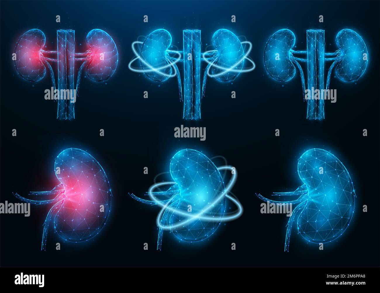 Set of polygonal vector illustrations of inflamed diseased kidney ...
