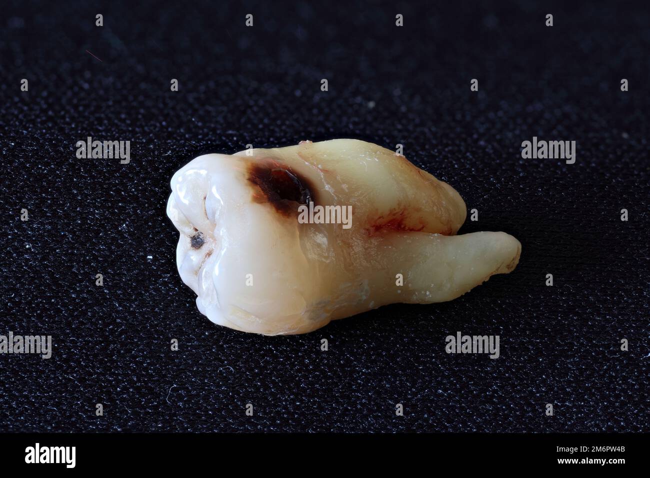 Wisdom tooth removal hi-res stock photography and images - Alamy