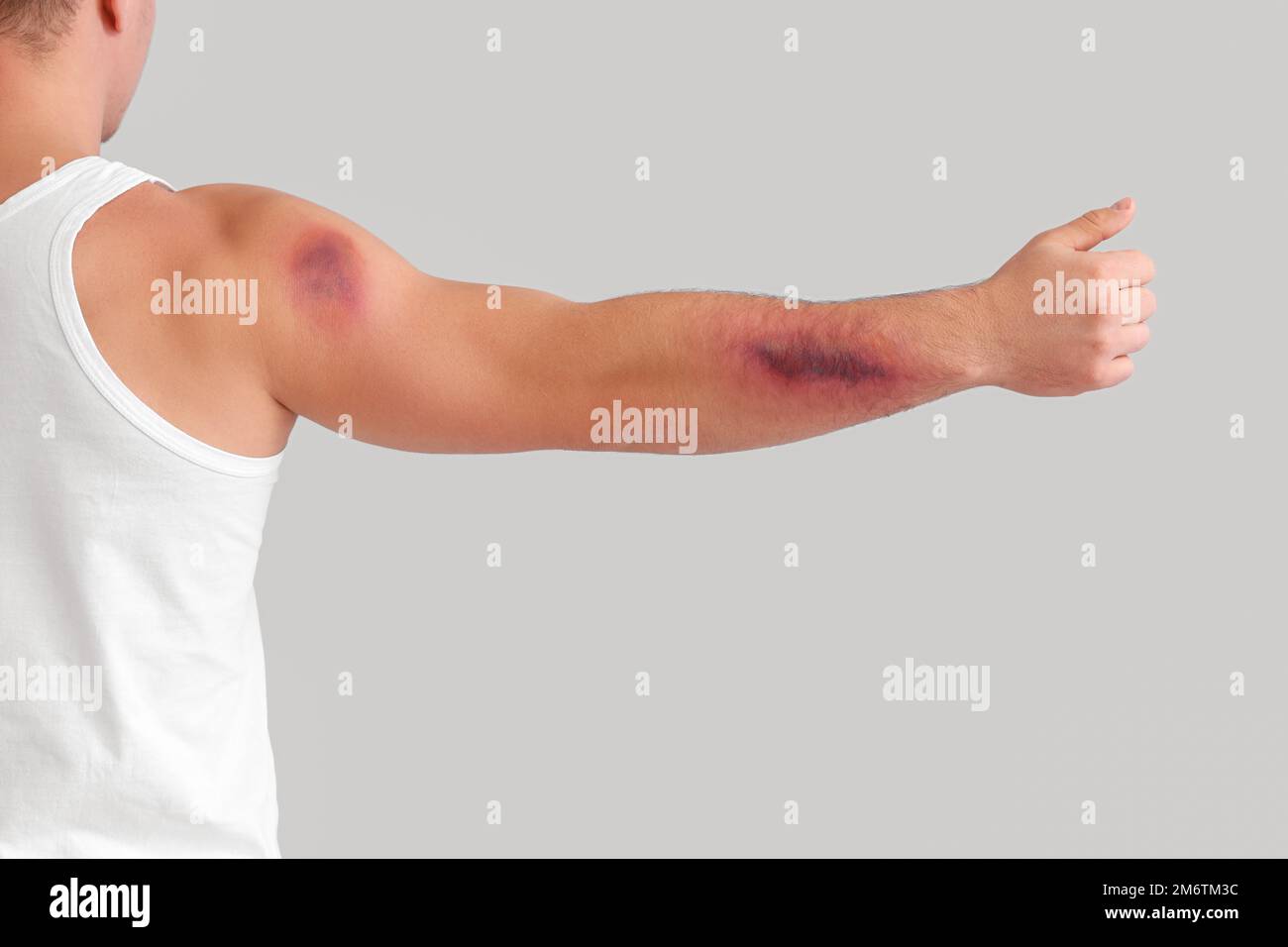 Man with bruises on arm against light background Stock Photo - Alamy
