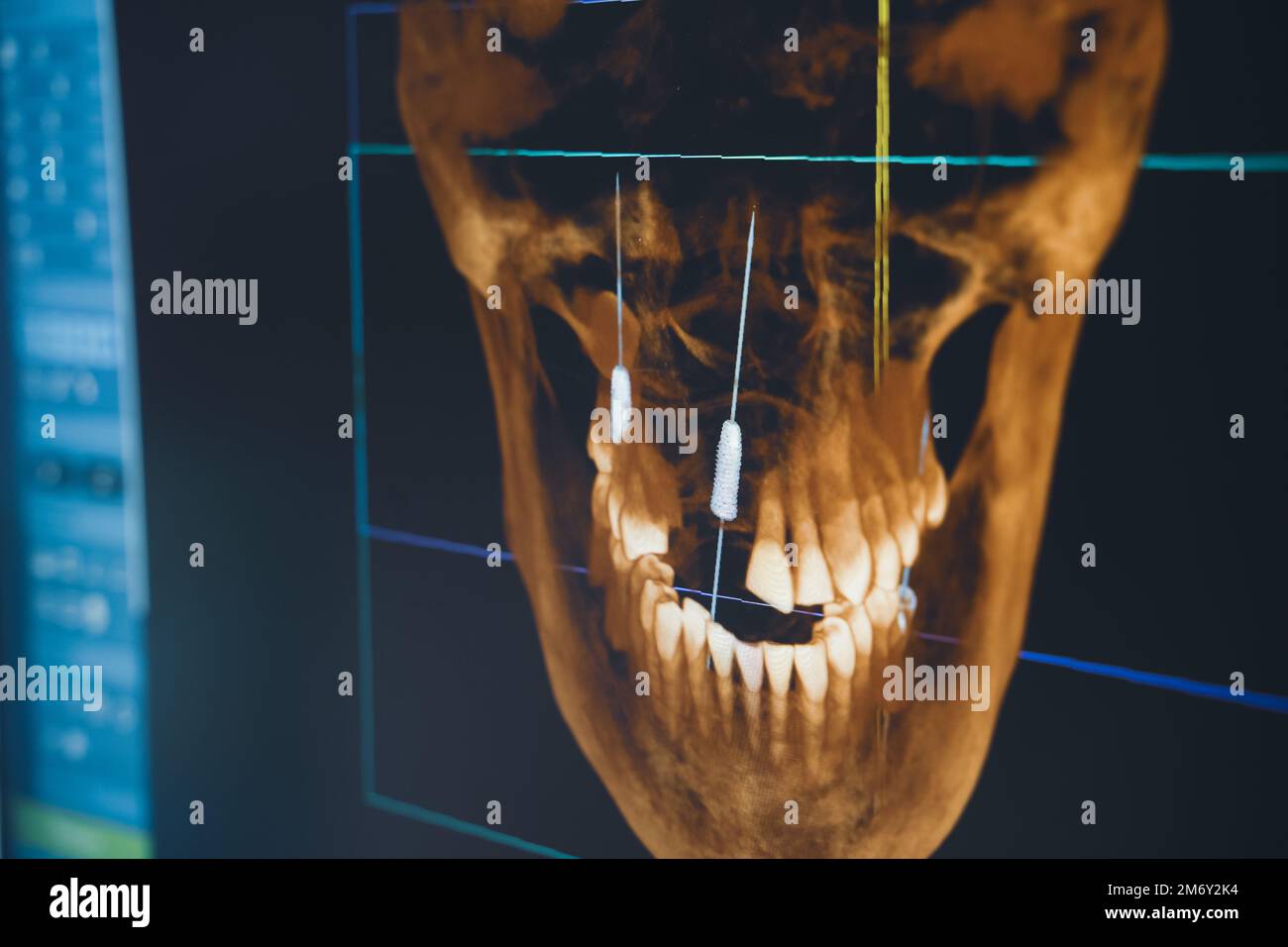 closeup of software interface of dental radiography x-ray on digital ...