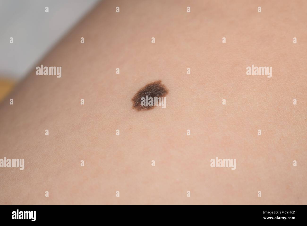 Skin irregularities hi-res stock photography and images - Alamy