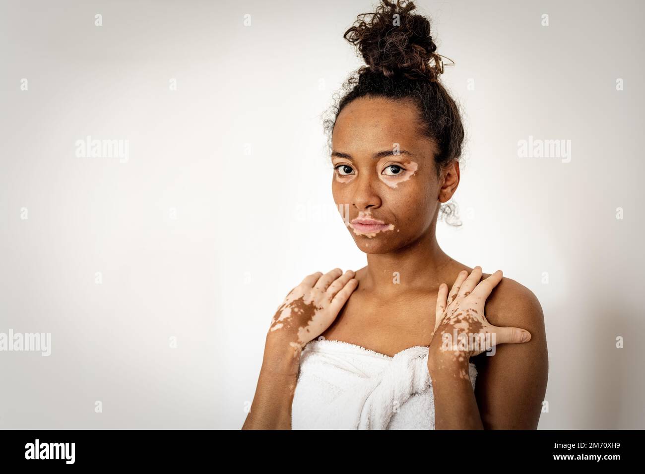 Beautiful young african american woman with vitiligo posing with towel ...