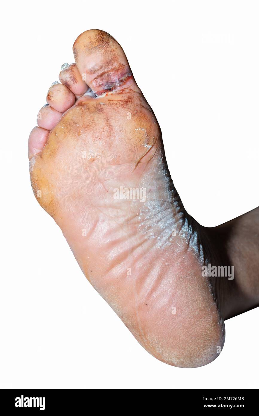 Lacerated wound Cut Out Stock Images & Pictures - Alamy