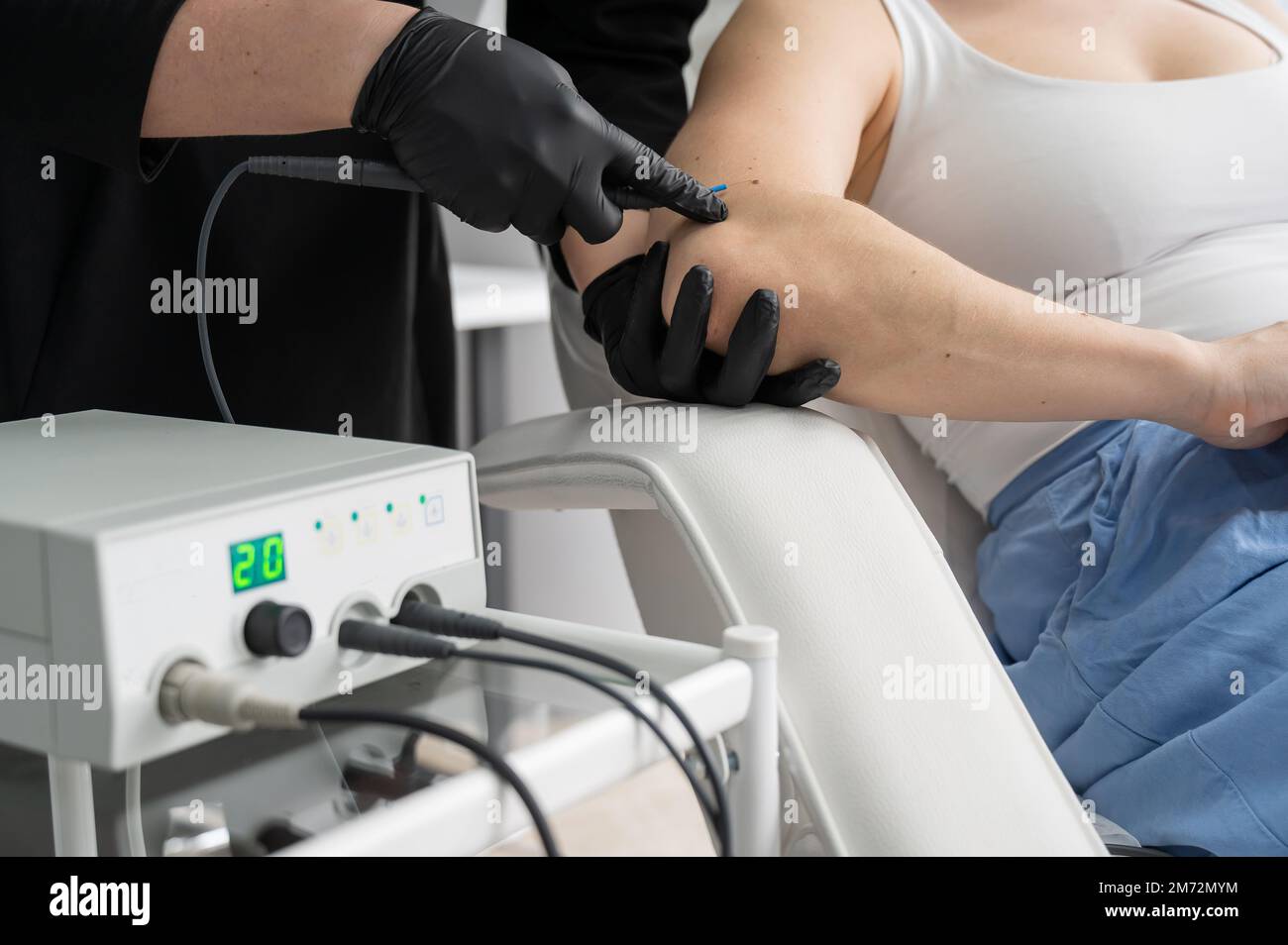 Dermatologist removes a mole on a patient's arm using an ...