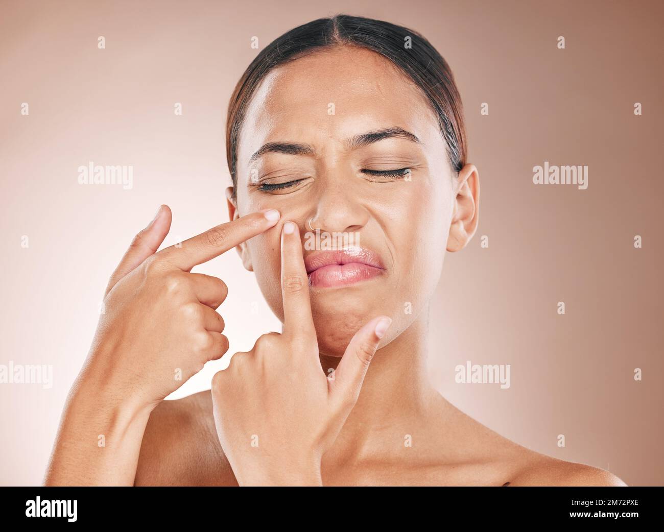 Skincare, pimple and breakout with a model black woman in studio on a ...