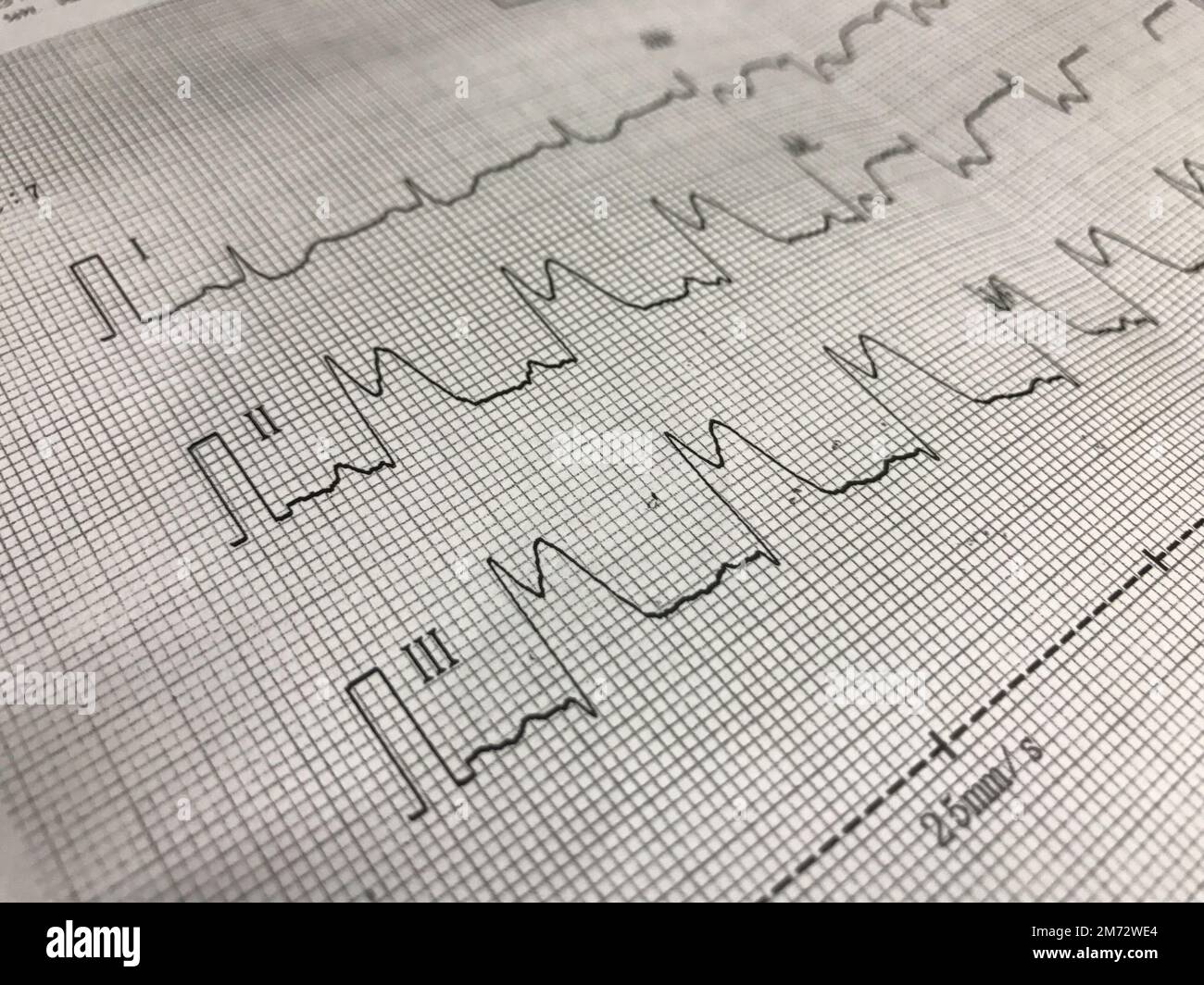 Close up ST elevation in leadI ll, lll on ECG paper Stock Photo - Alamy