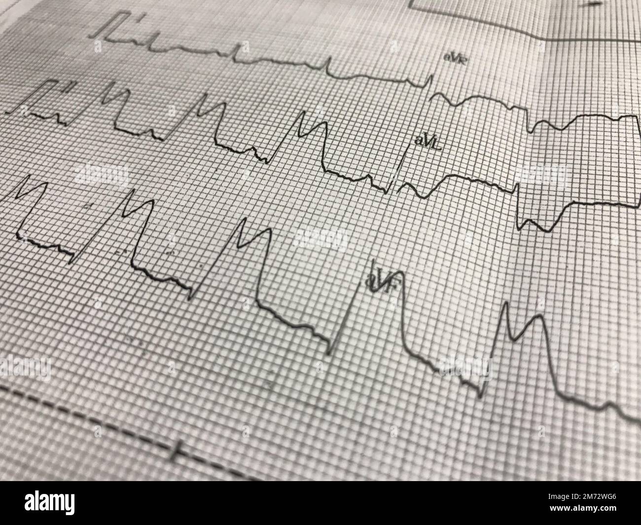Close up ST elevation in leadI ll,lll on ECG paper Stock Photo - Alamy