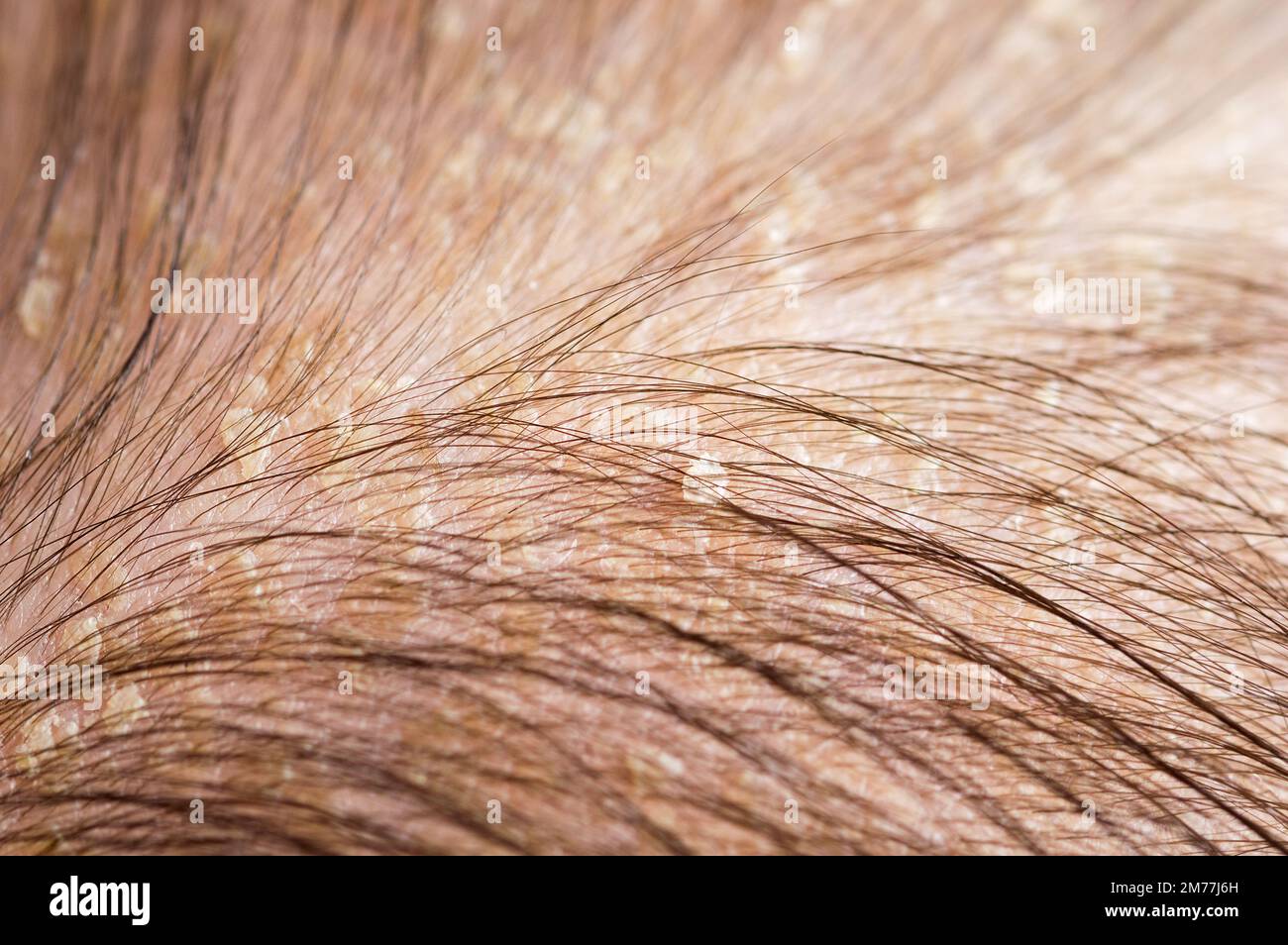 Newborn baby with psoriasis or dandruff in the hair Stock Photo - Alamy