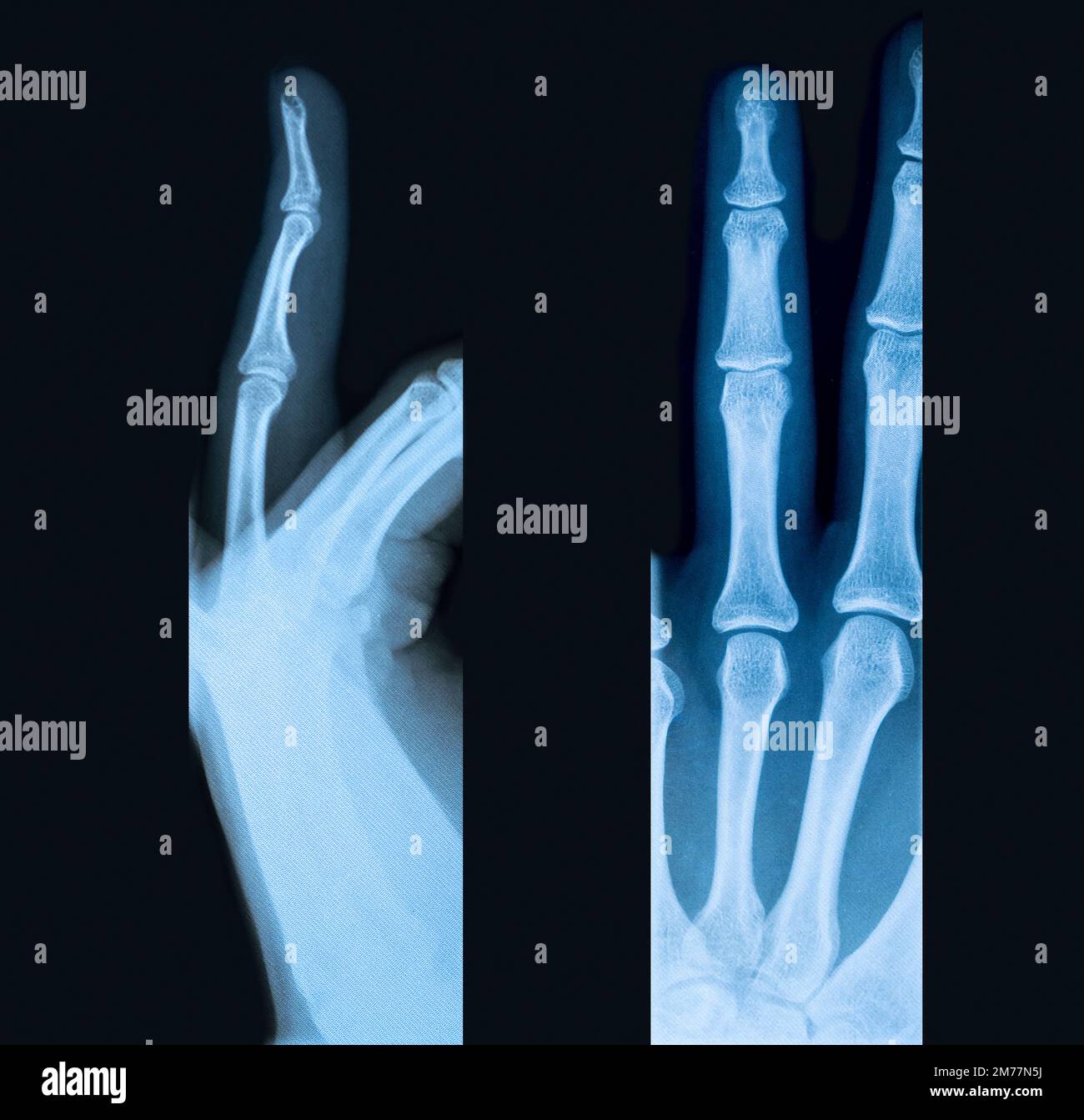 two x-ray of a broken finger Stock Photo - Alamy two x-ray of a broken finger Stock Photo - Alamy