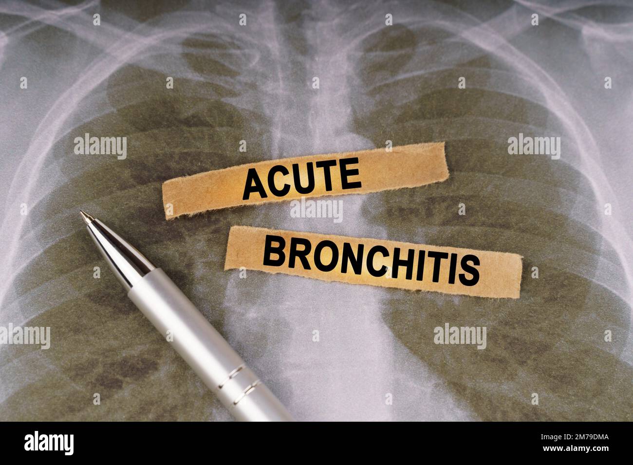 Chest X Ray Showing Acute Bronchitis at Darrel Ferreira blog