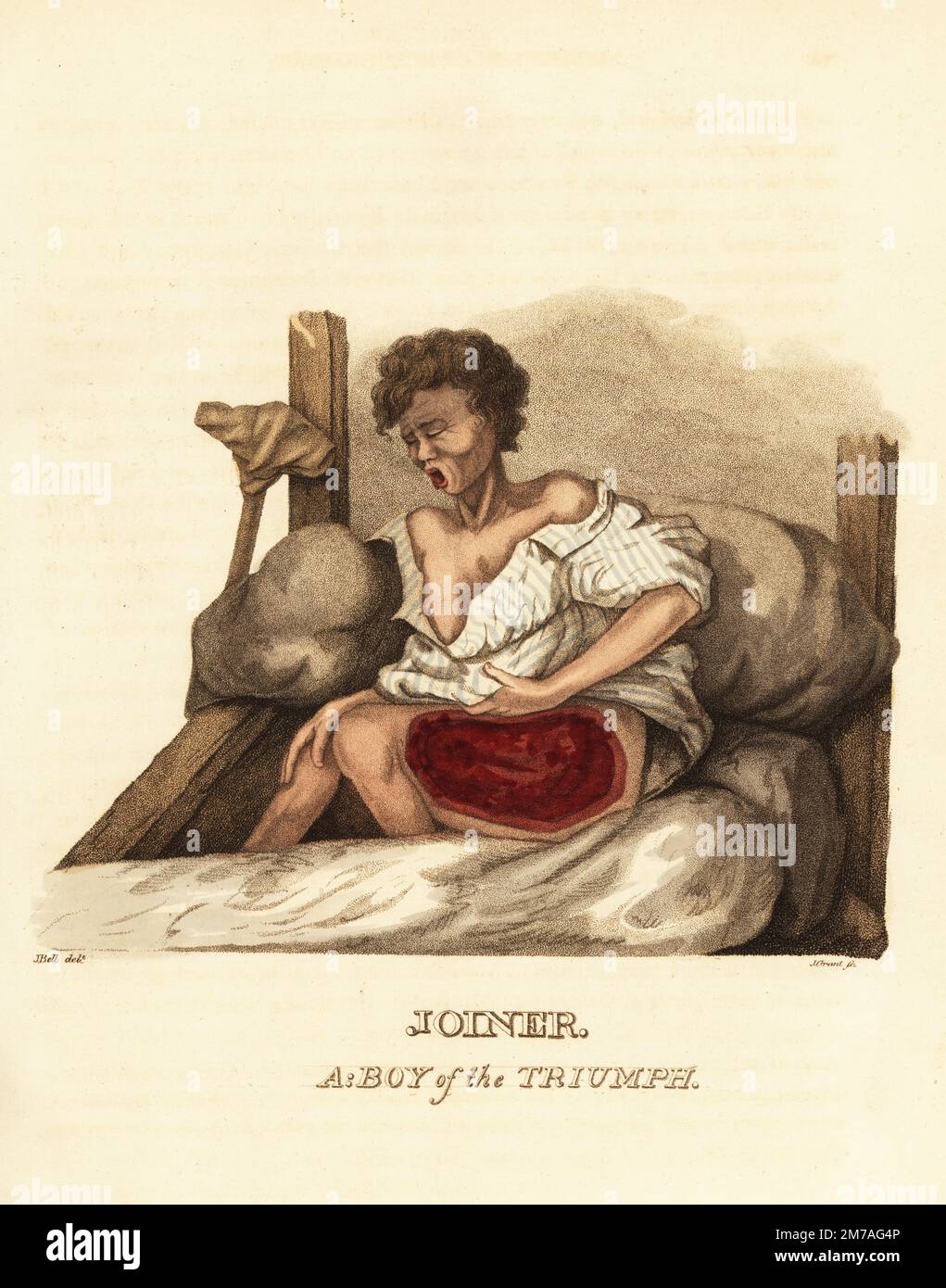 A boy with a huge sore wasting away the skin and muscle of the thigh ...